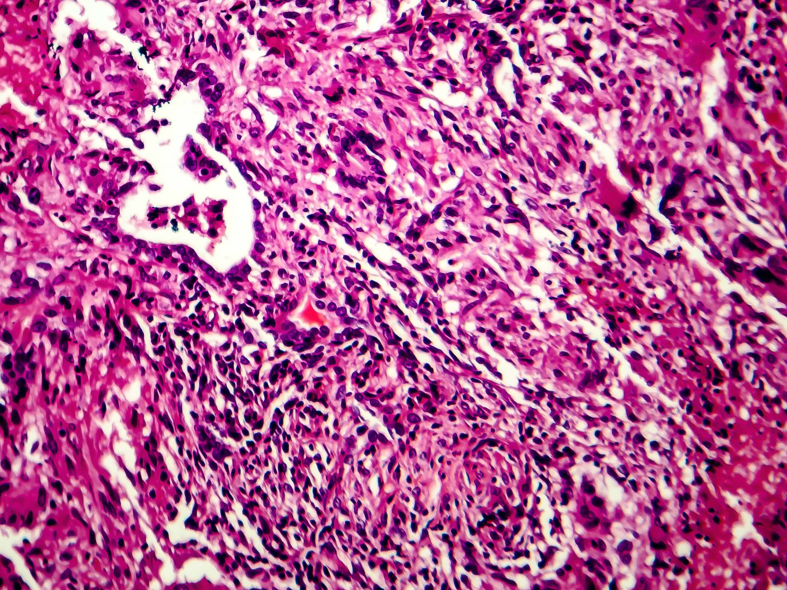 Tuberculinum: in der Homöopathie